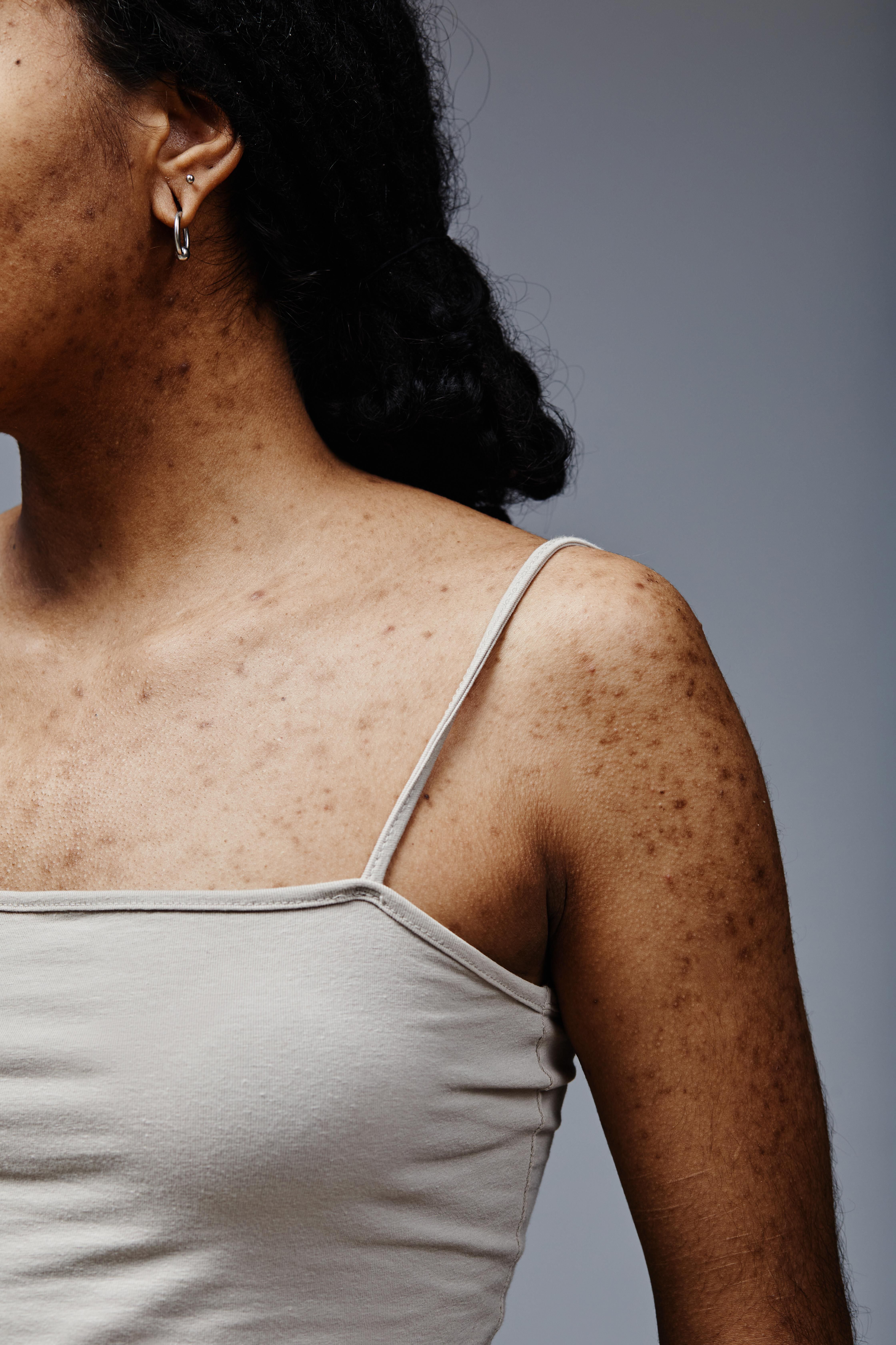 Hyperpigmentation post-inflammatoire : nos conseils | La Roche-Posay