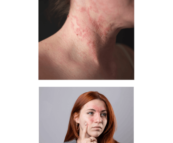 Eczéma visage : causes, symptômes et traitements | La Roche-Posay